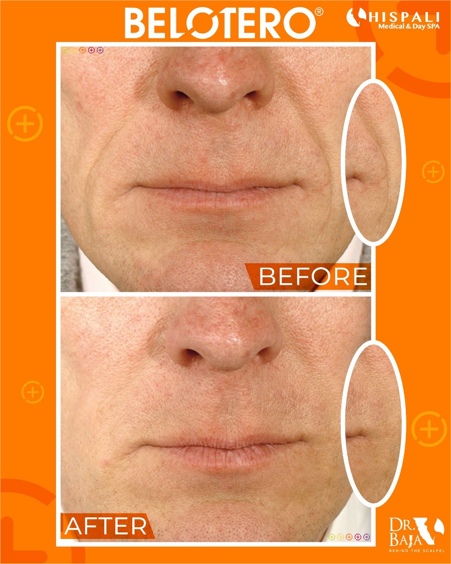 Belotero | Ácido Hialurónico: Relleno Facial - Dr. Baja