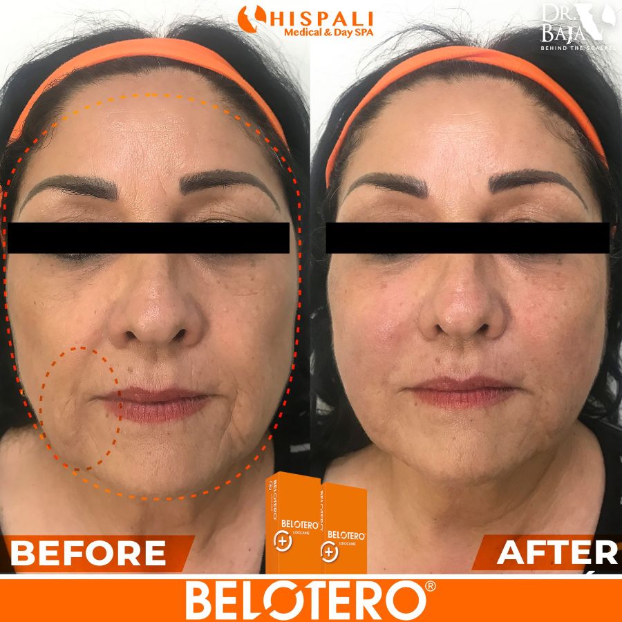 Belotero | Ácido Hialurónico: Relleno Facial - Dr. Baja