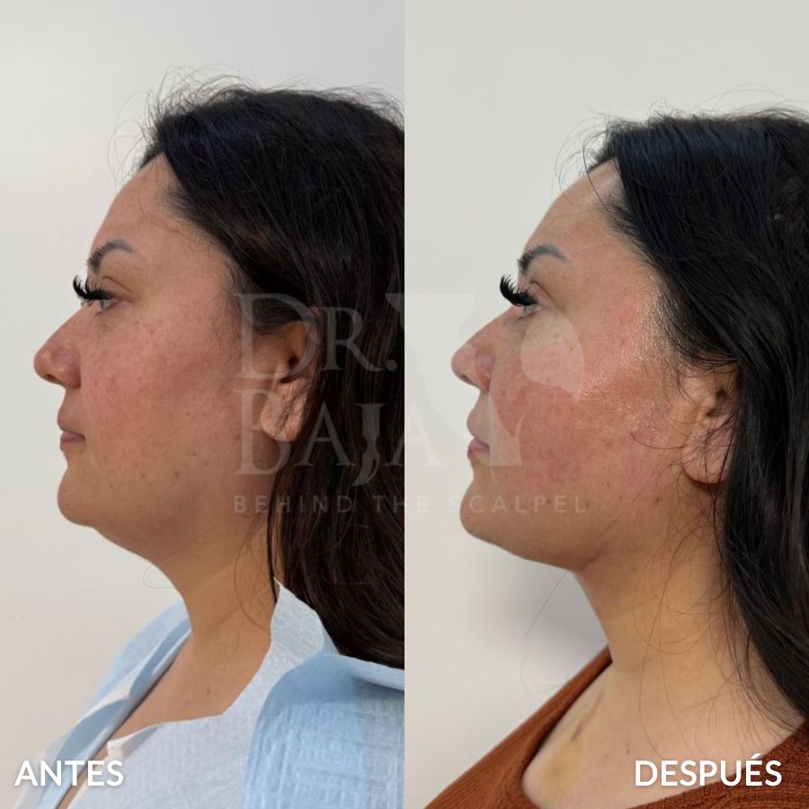 Endolift Facial: Rejuvenate your face without surgery - Dr. Baja
