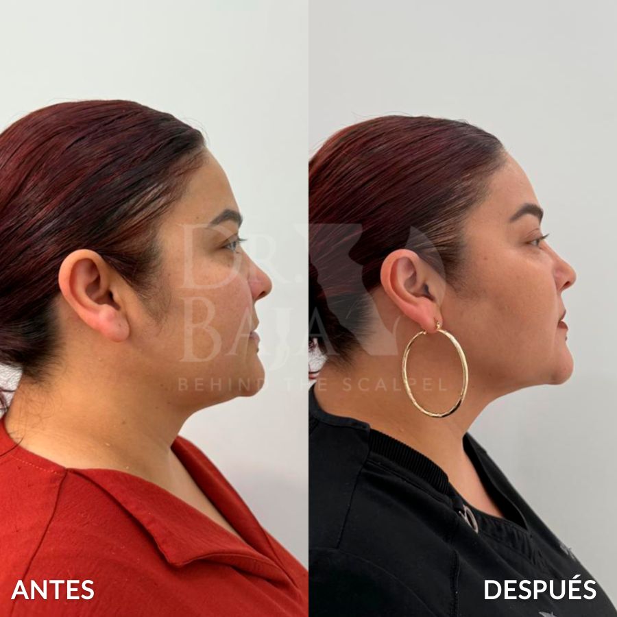 Endolifting Facial: Rejuvenece tu rostro sin cirugía - Dr. Baja