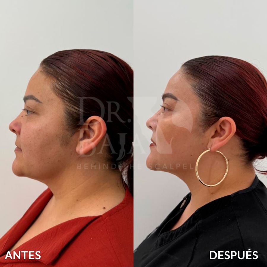 Endolift Facial: Rejuvenate your face without surgery - Dr. Baja