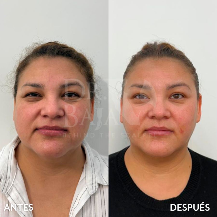 Endolift Facial: Rejuvenate your face without surgery - Dr. Baja