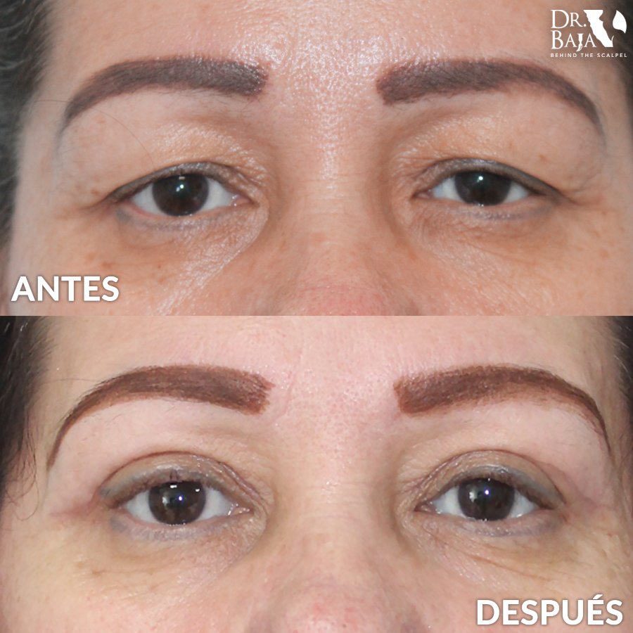 Blepharoplasty Results Dr Baja
