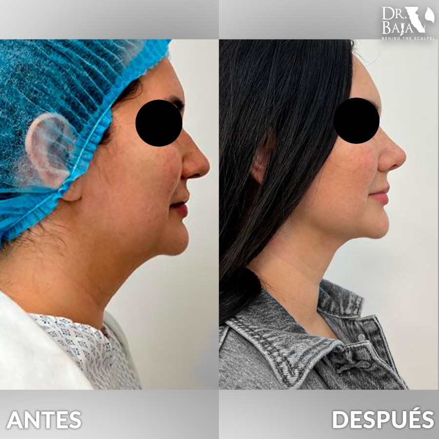 Perfilamiento Facial: Obtén un rostro equilibrado - Dr. Baja
